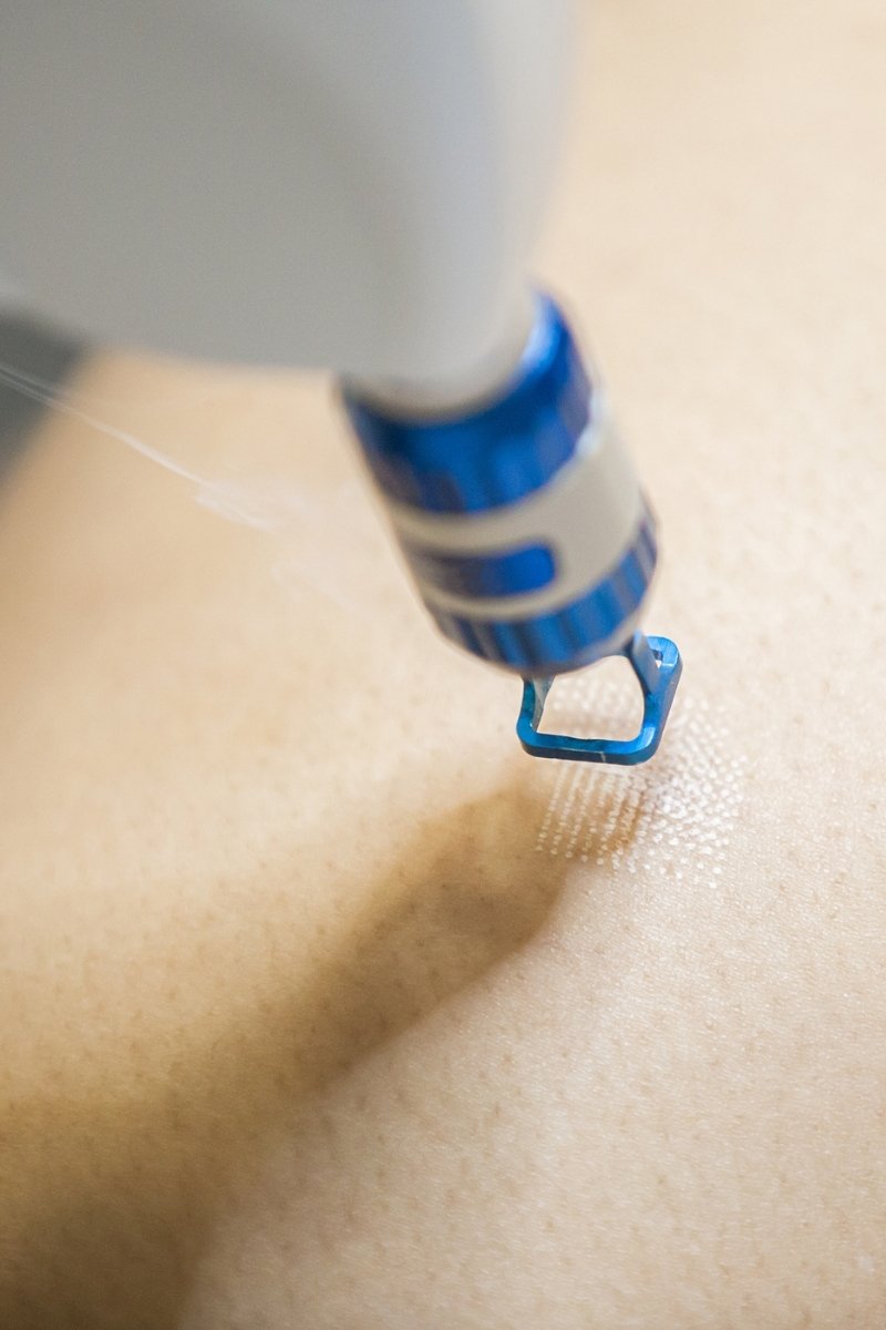 Fractional Laser Σώματος: Για ρυτίδες, ουλές, ραγαδες