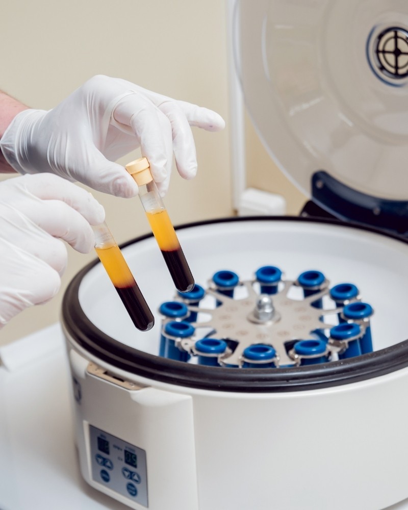 PRP Θεραπεία: Τι είναι, Εφαρμογή, Αποτελέσματα | THE ANTIAGERS